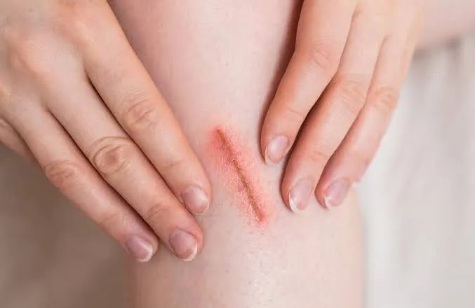 Entenda as diferenças entre ferida e ferimento - TV Pampa